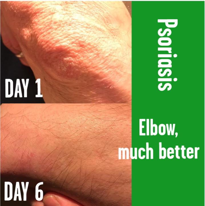 Psoriasis (3) x Fermented Green Papaya Enzyme